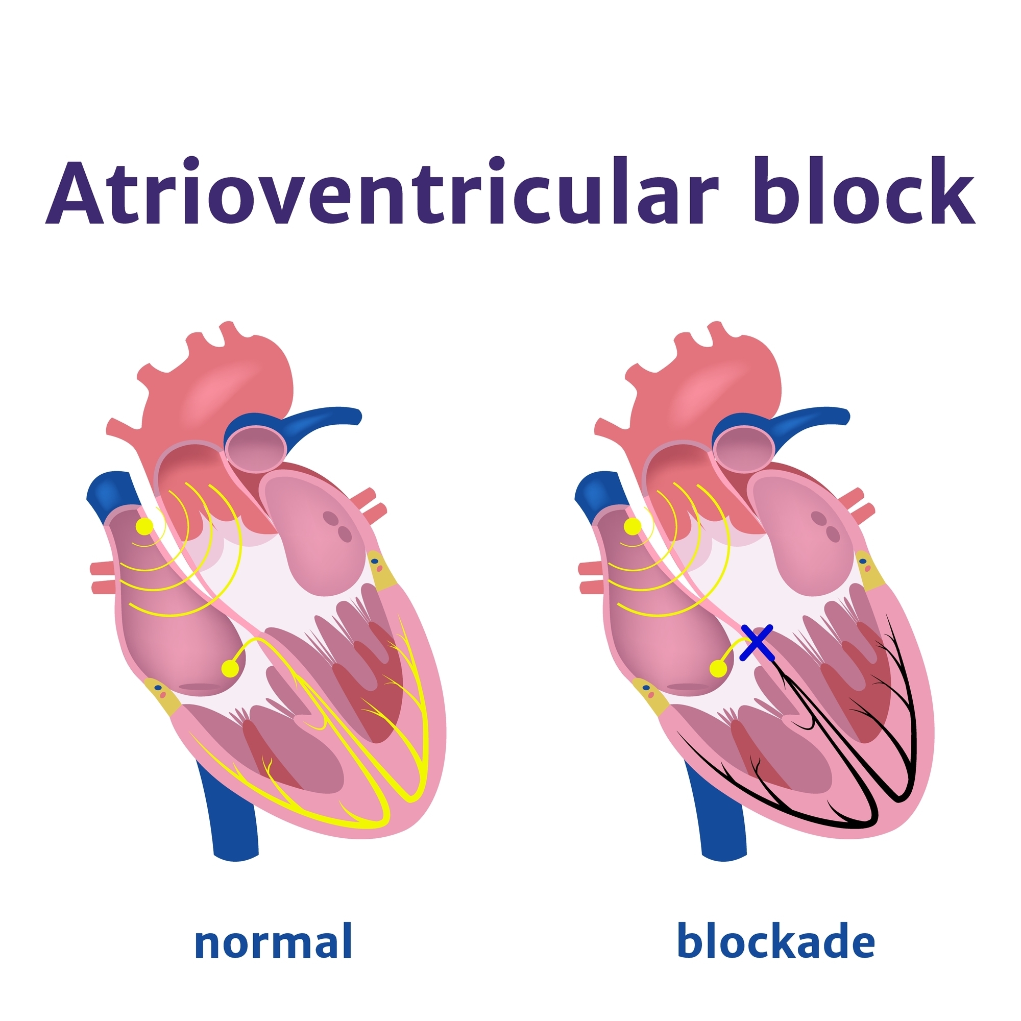 Heart Block: Causes, Symptoms, Management and Treatments | Medanta