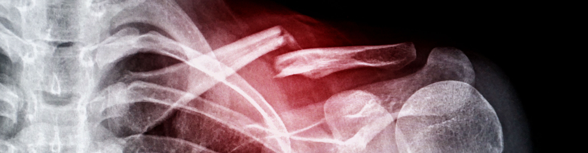 Severe Bone Fractures: Types, Symptoms & Treatment