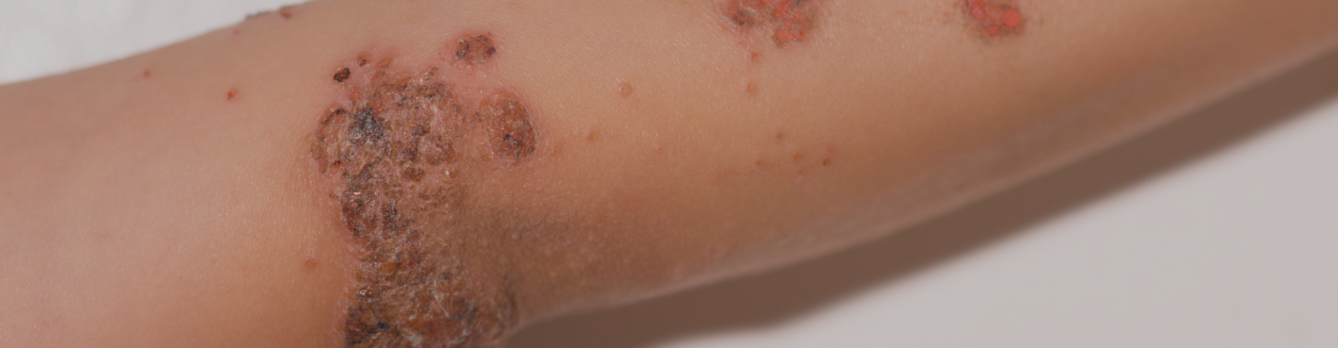 Impetigo: Symptoms, Causes, Risk, & Prevention