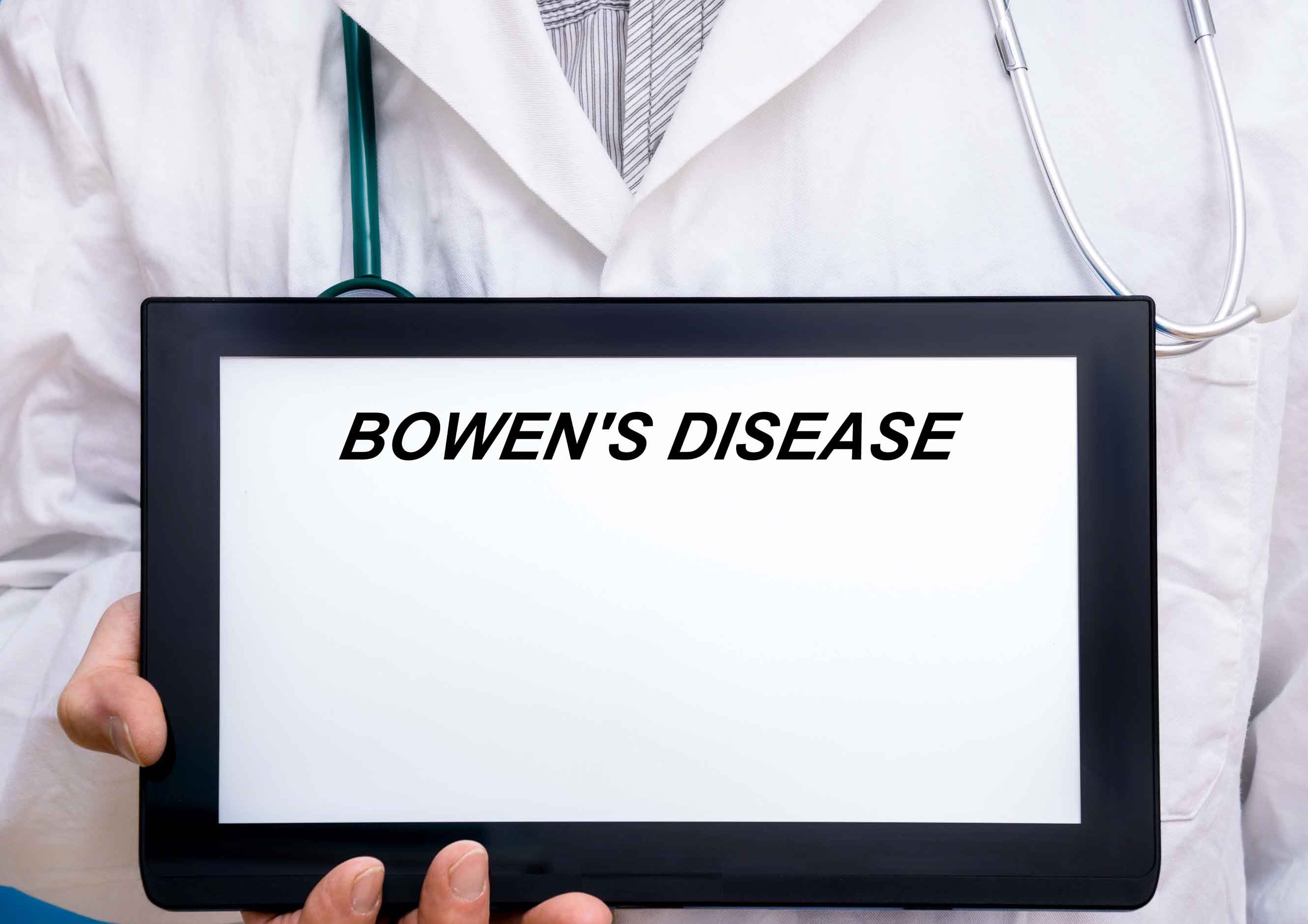 Bowen’s Disease - Identify the Symptoms for Skin Cancer Diagnosis | Medanta