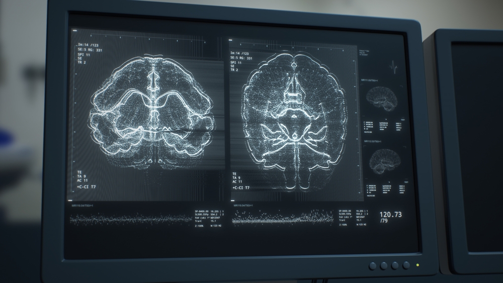 Brain Metastasis: Symptoms, Causes, Risk, & Prevention