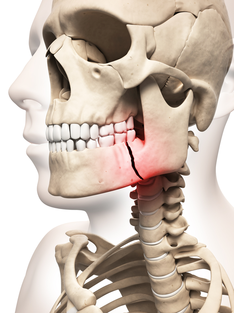 Maxillary & Mandibular Fractures Causes, Symptoms, Treatment in India ...