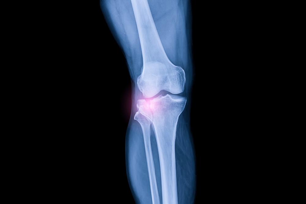 Severe Bone Fractures: Types, Symptoms & Treatment