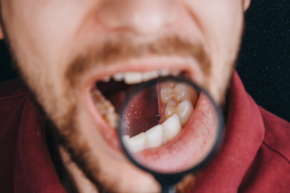Carcinoma Buccal Mucosa: Symptoms, Causes, Risk, & Prevention