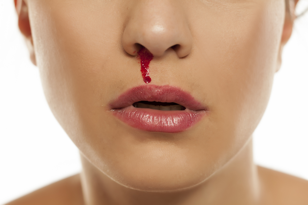 Epistaxis - Nose Bleeding Reasons, Causes, Symptoms & Treatment